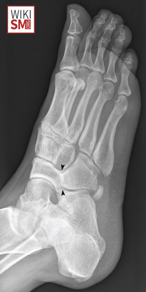 Cubonavicular Joint - WikiSM (Sports Medicine Wiki)