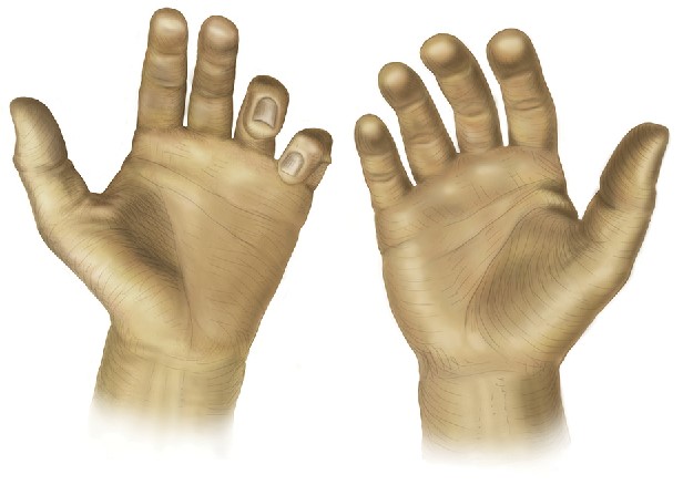 Massé Sign - Ulnar Neuropathy - WikiSM (Sports Medicine Wiki)