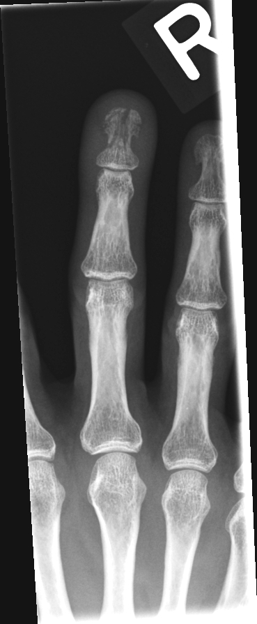 Phalanx Fractures Hand - WikiSM (Sports Medicine Wiki)