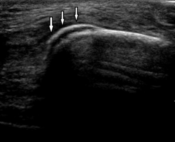 Patellar Pole Avulsion Fracture - WikiSM (Sports Medicine Wiki)