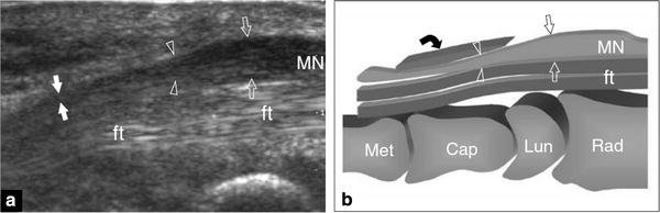Carpal Tunnel Syndrome - WikiSM (Sports Medicine Wiki)