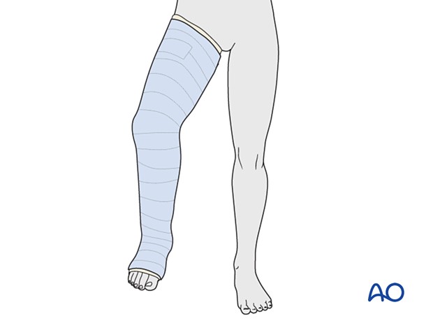 Long Leg Cast - WikiSM (Sports Medicine Wiki)