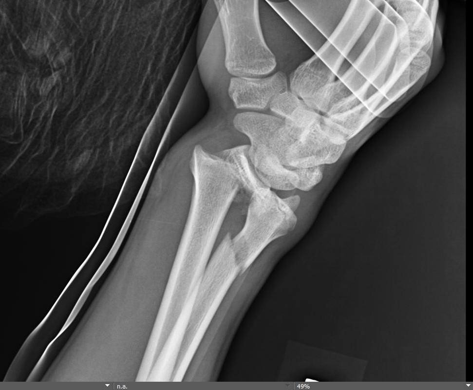 Salter Harris Fracture - WikiSM (Sports Medicine Wiki)