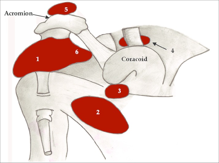 Subscapular Bursa - WikiSM (Sports Medicine Wiki)