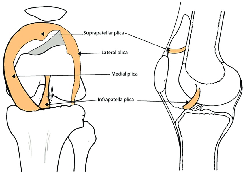 Suprapatellar Plica - WikiSM (Sports Medicine Wiki)