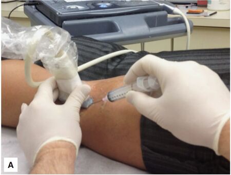 Distal Biceps Femoris Injection - WikiSM (Sports Medicine Wiki)