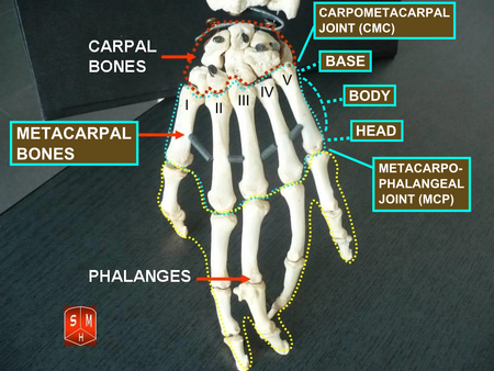 Metacarpal Bones - WikiSM (Sports Medicine Wiki)