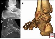 Os Trigonum - WikiSM (Sports Medicine Wiki)