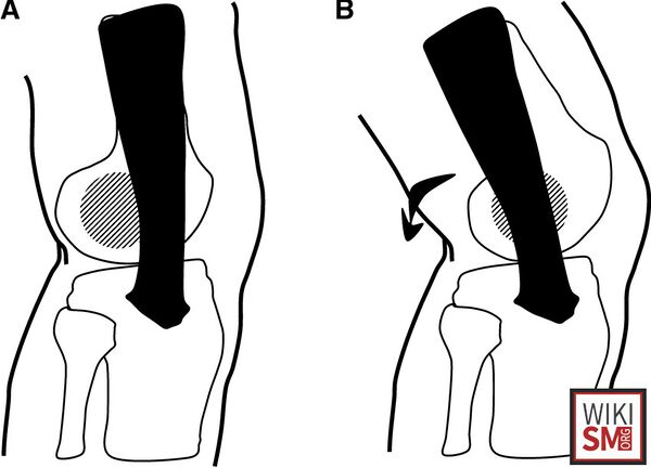 IT Band Syndrome - WikiSM (Sports Medicine Wiki)