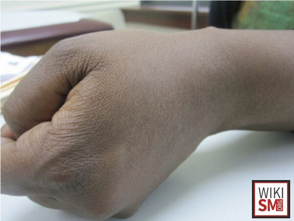 De Quervain’s Tenosynovitis - WikiSM (Sports Medicine Wiki)