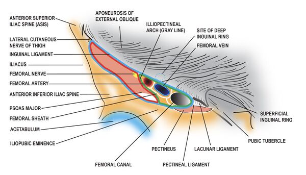 Femoral Hernia - WikiSM (Sports Medicine Wiki)