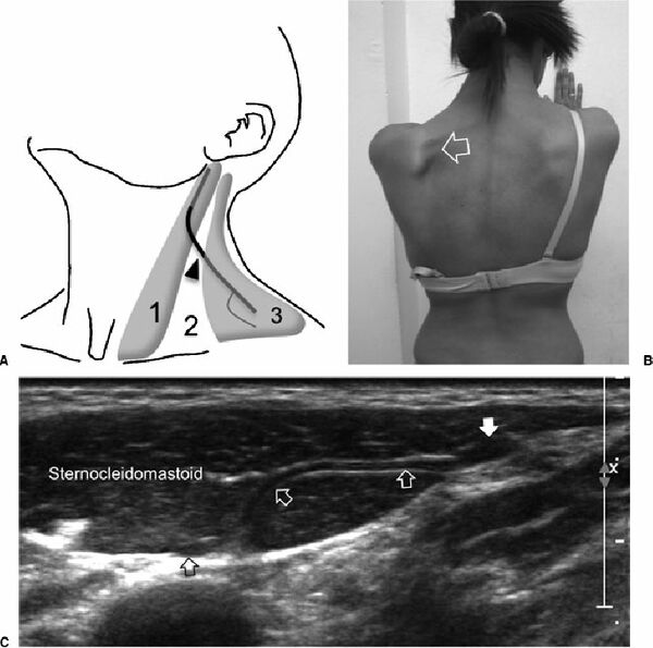 Spinal Accessory Nerve - WikiSM (Sports Medicine Wiki)