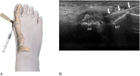 First Metatarsophalangeal Joint Injection - WikiSM (Sports Medicine Wiki)