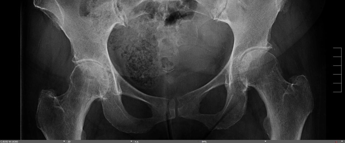 Hip Osteoarthritis - WikiSM (Sports Medicine Wiki)
