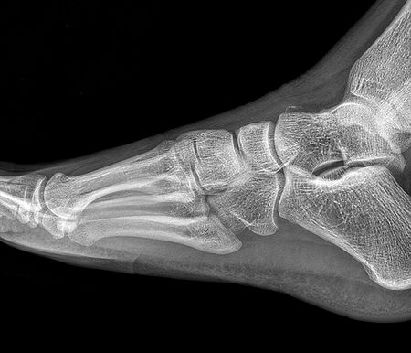 Talonavicular Joint - WikiSM (Sports Medicine Wiki)