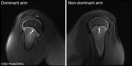 Humeral Head Epiphysiolysis - WikiSM (Sports Medicine Wiki)