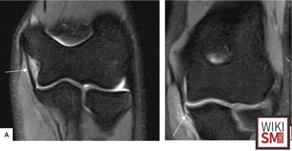 UCL Tear of the Elbow - WikiSM (Sports Medicine Wiki)