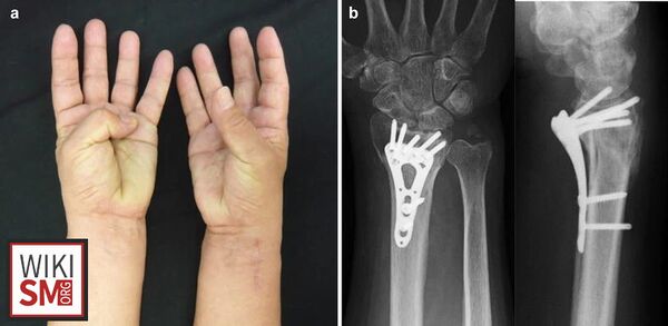 Flexor Pollicis Longus Rupture - WikiSM (Sports Medicine Wiki)