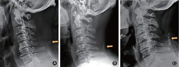 Nuchal Ligament - WikiSM (Sports Medicine Wiki)