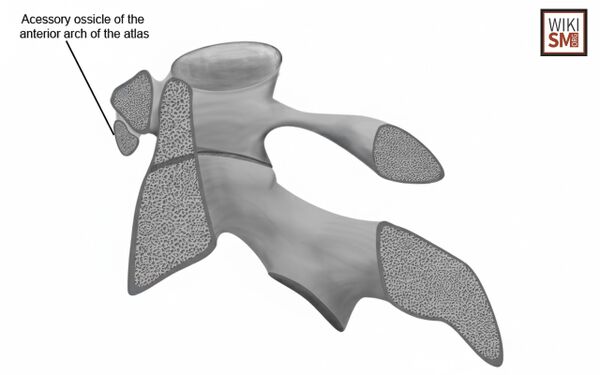 Accessory Ossicle of the Anterior Arch of the Atlas - WikiSM (Sports ...