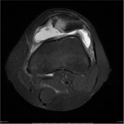 Patellar Dislocation - WikiSM (Sports Medicine Wiki)