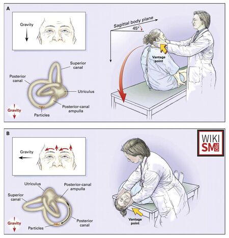 Dix Hallpike Maneuver - WikiSM (Sports Medicine Wiki)