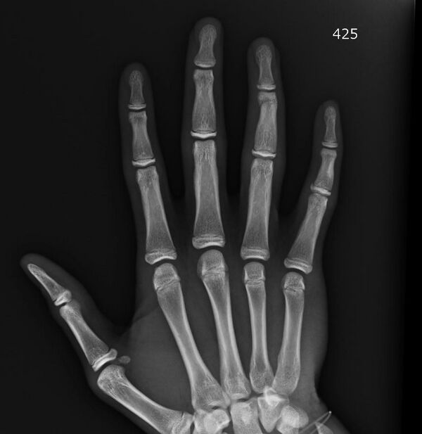 Finger Pain - WikiSM (Sports Medicine Wiki)