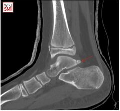 Os Trigonum - WikiSM (Sports Medicine Wiki)