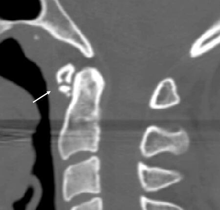 Accessory Ossicle of the Anterior Arch of the Atlas - WikiSM (Sports ...