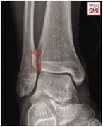 Ankle Syndesmosis - WikiSM (Sports Medicine Wiki)