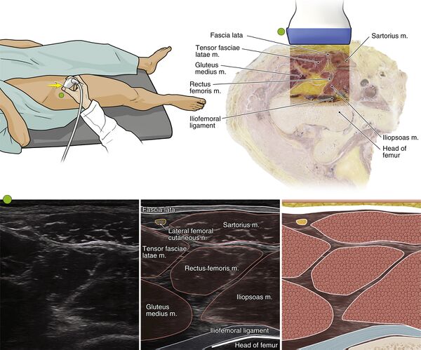 Hip Flexor Tendonitis - WikiSM (Sports Medicine Wiki)