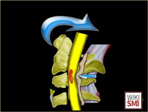 Cervical Teardrop Fracture - WikiSM (Sports Medicine Wiki)
