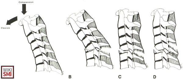 Cervical Teardrop Fracture - WikiSM (Sports Medicine Wiki)