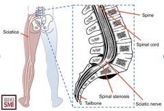 Sciatic Nerve - WikiSM (Sports Medicine Wiki)