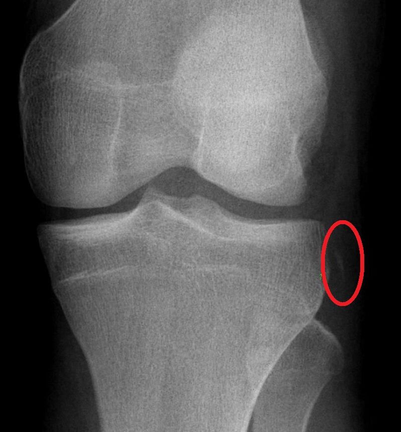 Segond Fracture - WikiSM (Sports Medicine Wiki)