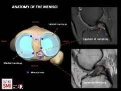 Meniscus Anatomy - Medial and Lateral - WikiSM (Sports Medicine Wiki)
