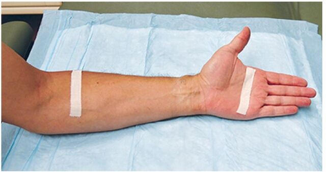 Short Arm Cast - WikiSM (Sports Medicine Wiki)