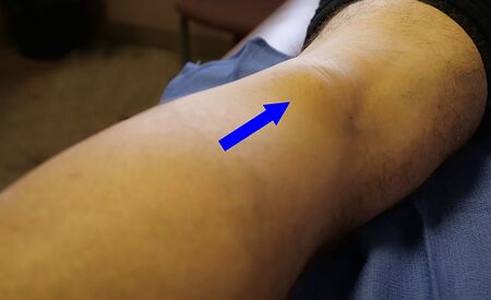 Baker's Cyst - WikiSM (Sports Medicine Wiki)
