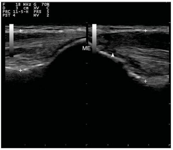 Common Flexor Tendon Percutaneous Tenotomy - WikiSM (Sports Medicine Wiki)