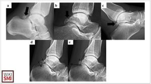 Os Trigonum - WikiSM (Sports Medicine Wiki)