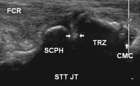 Scaphotrapeziotrapezoidal Joint Injection - WikiSM (Sports Medicine Wiki)