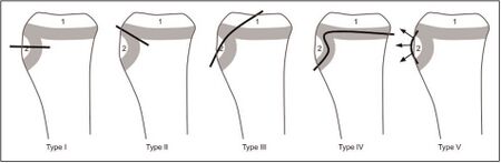 Tibial Tubercle Avulsion Fracture - WikiSM (Sports Medicine Wiki)