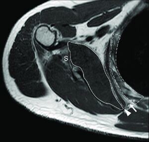 Scapulothoracic Joint - WikiSM (Sports Medicine Wiki)