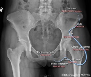 Iliac Crest - WikiSM (Sports Medicine Wiki)