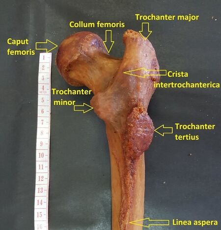 Greater Trochanter - WikiSM (Sports Medicine Wiki)