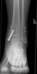 Syndesmotic Injury - WikiSM (Sports Medicine Wiki)