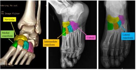 Cuneiform Bones - WikiSM (Sports Medicine Wiki)