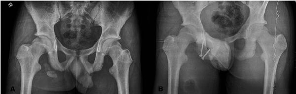 Avulsion Fractures of the Pelvis - WikiSM (Sports Medicine Wiki)