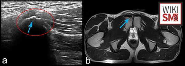 Adductor Tendinopathy - WikiSM (Sports Medicine Wiki)