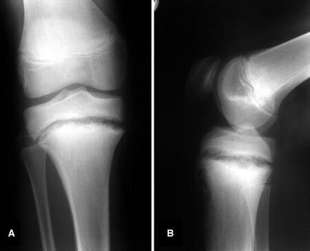 Proximal Tibial Physeal Injury - WikiSM (Sports Medicine Wiki)